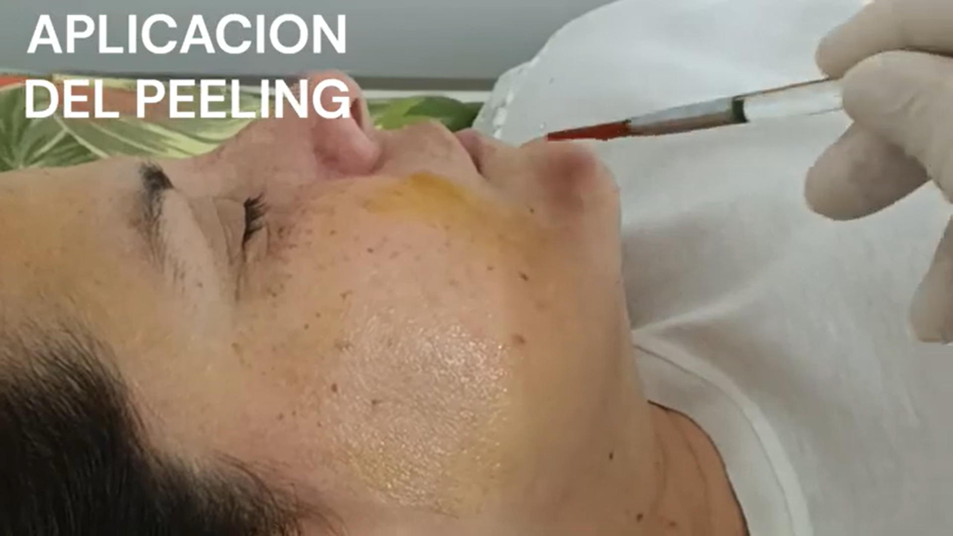 Peeling Facial - Beneficios y Tratamiento | Dermatología y Estética